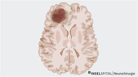 Brain Metastases Neurosurgery Inselspital Bern