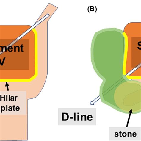 Clinical Application Of The Segment Iv Approach Diagonal Line Of Download Scientific Diagram