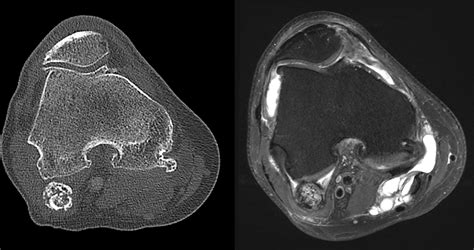 Knee Intra Articular Loose Body Causing A Compression Common Peroneal