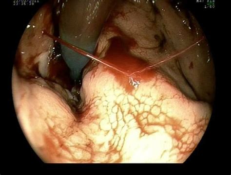 Cardiac Varices With Bleeding Download Scientific Diagram
