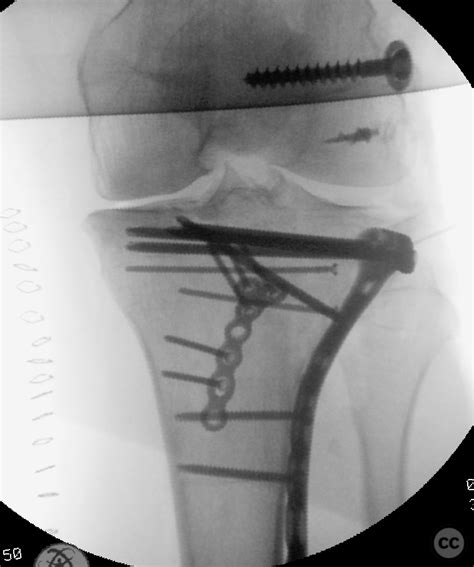 Posterolateral Approach To The Tibial Plateau With Femoral Epicondylar
