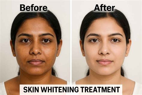Skin Lightening Before After Result India Dr Reema Arora