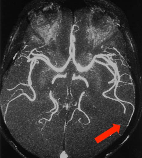 Ramped Flip Angle Questions And Answers In Mri