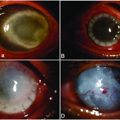 A Pythium Keratitis Presenting As Central Corneal Infiltrate In The Download Scientific