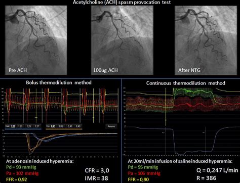 Contemporary And Future Invasive Coronary Vasomotor Function Testing