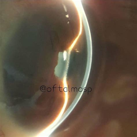 Photo Credit On Photo Ophthalmology Notes And Synopses
