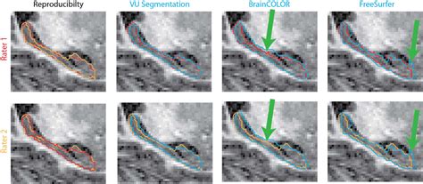 Multi Scale Hippocampal Parcellation Improves Atlas Based Segmentation