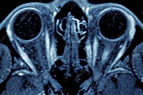 Multiple Sclerosis In The Optic Nerve Mri Stock Image C058 4685 Science Photo Library