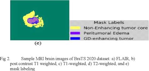 Figure 2 From Effective Mri Based Brain Tumor Detection Using Modified U Net Model Semantic
