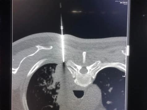 The Filipino Interventional Radiologist