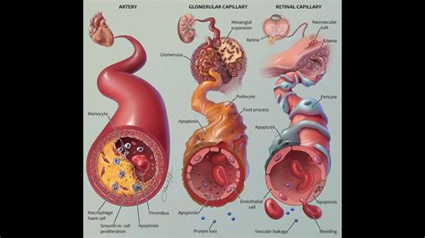 Microvascular Disease And Diabetes By Dr Dhara Patel Youtube