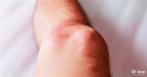 Cellulitis Knee
