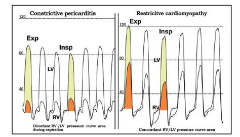 Constrictive Vs Restrictive Cardiomyopathy Drsvenkatesan Md