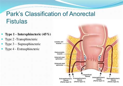 Fistula In Ano Types