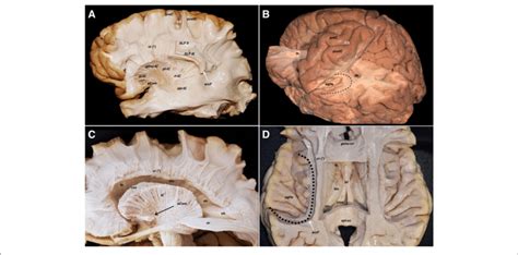 A The Corona Radiata Is Exposed In Relation To The Parietal Parts