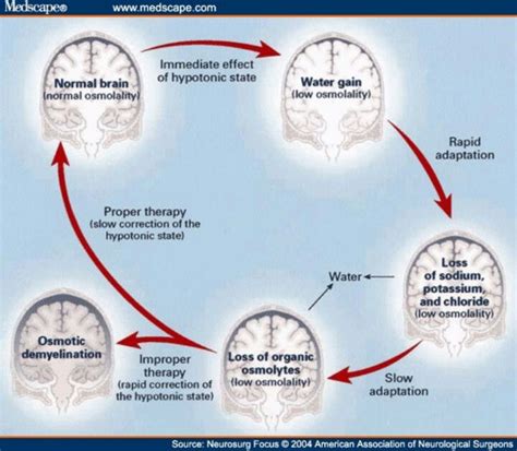Osmotic Demyelination Medical Information Neurology Medical