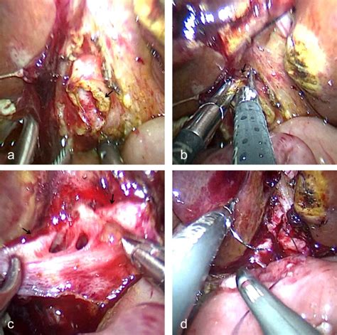 Single Incision Laparoscopic Hepaticojejunostomy With Selective Ductoplasty For Type Iv A