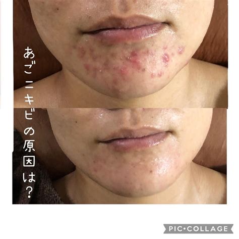 あごニキビの原因は？ 口コミ、ビフォーアフター多数！西明石駅すぐ！リアボーテ正規取扱店『ハピモア』
