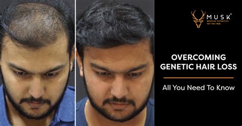 Treatment Of Genetic Hair Loss At Martha Ehrlich Blog