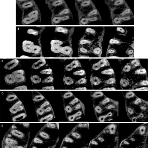 Some Of The Root Canal Variations Observed In The Mb Root A 1 2 3 2