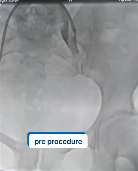 Interventionalradiology Dvt Thrombectomy Angiojet Patientcare