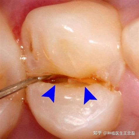 救命做了根管治疗后没做冠修复结果牙齿咬劈了还有救吗 知乎
