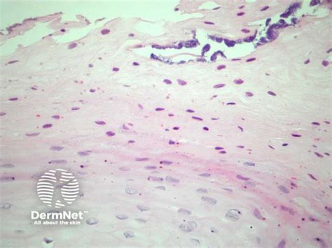 Oral Leukoplakia Pathology Outlines