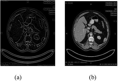 1 Kernels Matrix For Laplacian Of Gaussian Preprocessing Of The Image