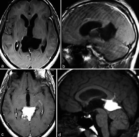 Epidermoid Cyst Brain