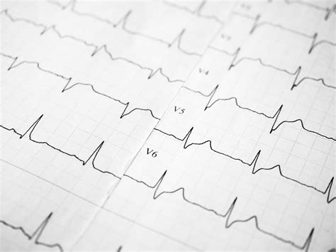 Detecting Underlying Paroxysmal Atrial Fibrillation For Zenicor Modulai