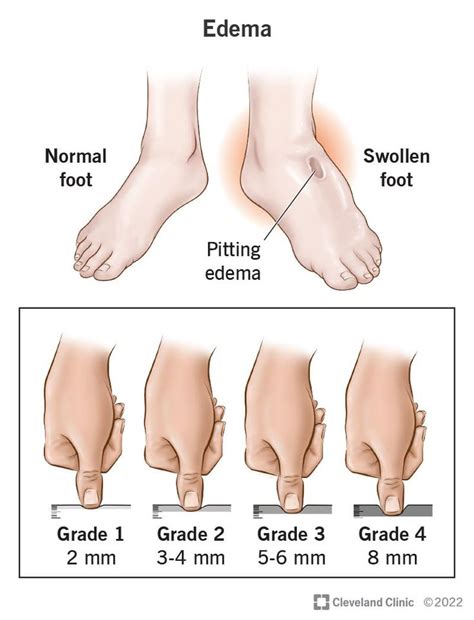 Edema Tipos Sintomas Causas E Tratamentos Iacv