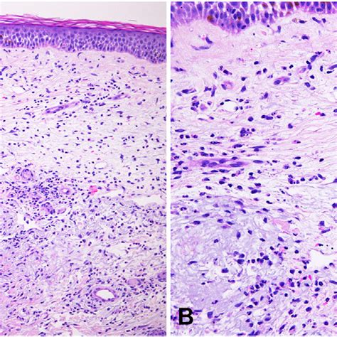 A B Light Microscopy Studies Of A Skin Biopsy Specimen Obtained From