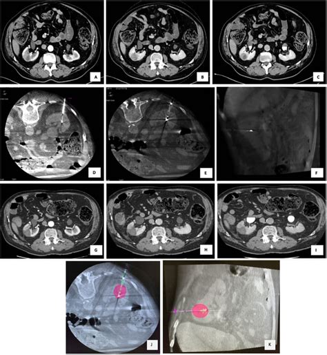 150 W Microwave Ablation Mwa Of Renal Carcinoma In A 74 Year Old Man Download Scientific