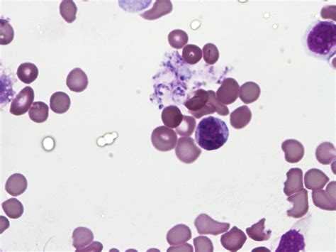 Diagnosis Of Pneumocystis Sfmm
