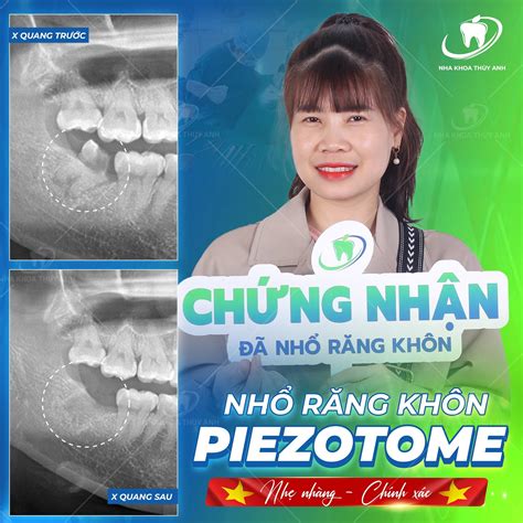 Nhổ Răng Khôn Mấy Ngày Thì Lành Thương Nha Khoa Thùy Anh Nhakhoathuyanh
