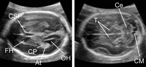 Cavum Septum Pellucidum Fetal Ultrasound