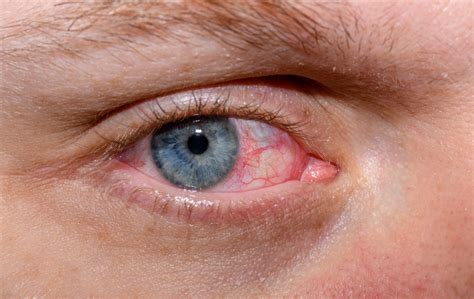 Dry Eye Disease Causes Symptoms And Effective Treatments Anderson