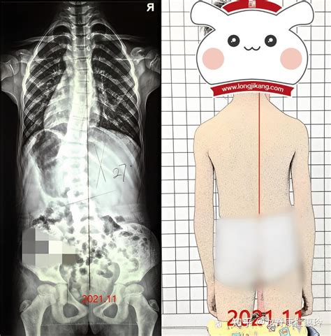 9岁侧弯女孩治疗半年后度数大减13度体态恢复正常 知乎
