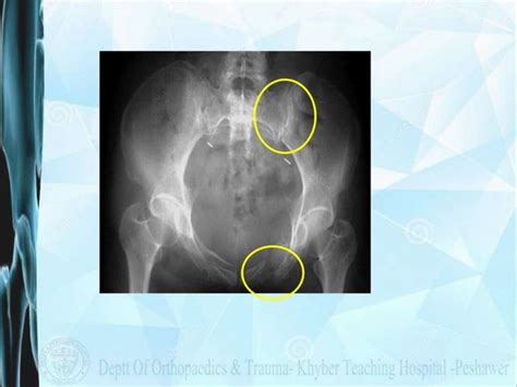Pelvic Fracture Classification Ppt