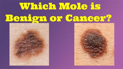 Normal Mole Vs Melanoma Skin Cancer Screening Md Anderson Cancer