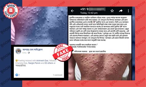 Old Image Of Chicken Pox Affected Patient Circulated As Morphin Virus