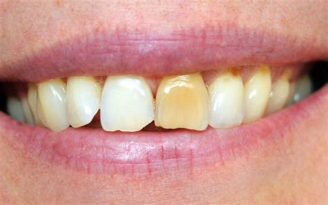 Brown Stains On Teeth Causes And Treatment In Bassendean
