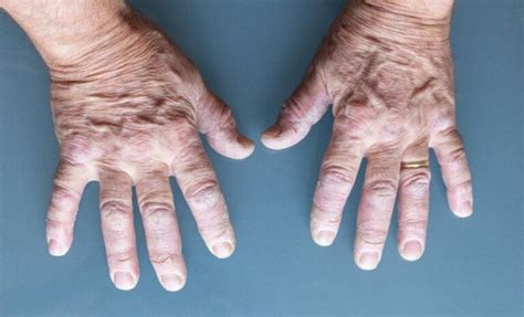 New Eular Guidelines On Systemic Sclerosis Medical Independent