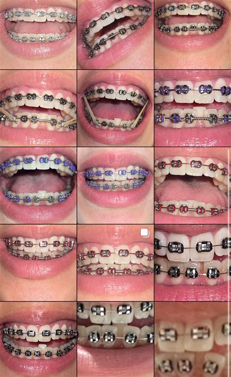 8 Months No Ipr Or Extraction R Braces
