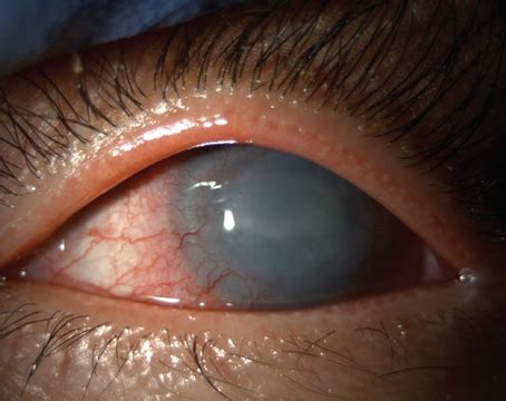 Attacking Acanthamoeba Keratitis