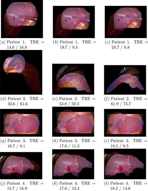 Figure 1 From Automatic 3d2d Deformable Registration In Minimally Invasive Liver Resection
