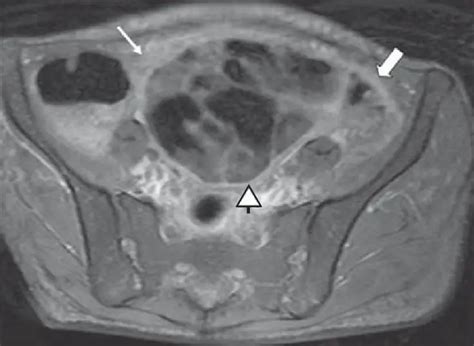 Diffuse Peritonitis Causes Symptoms Diagnosis Prescribed Treatment