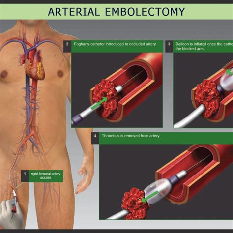 Embolectomy Dr Rakesh Jain