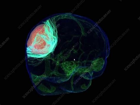 Brain Tumour Dti Mri Scan Stock Video Clip K003 9459 Science Photo Library