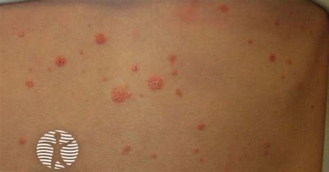 Guttate Psoriasis Image